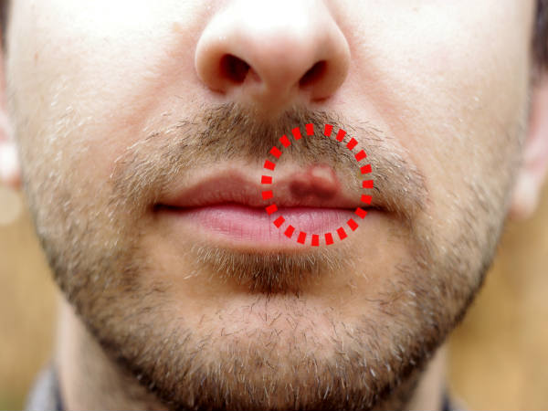 इंटिमेट होते समय ना लें लव बाइट... यह ले सकता है आपकी जान | Are Hickeys ...