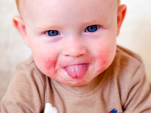 Drool Rashes In Baby: लार से भी हो सकते हैं बच्‍चों के चेहरे पर दाने और ...