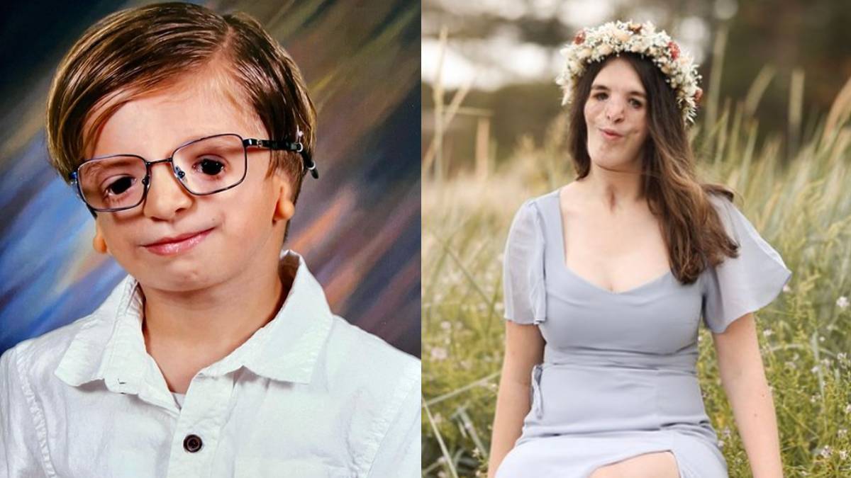 इस अजीब बीमारी में बच्चे के चेहरे का आकार हो जाता है खराब, जानिए लक्षण ...