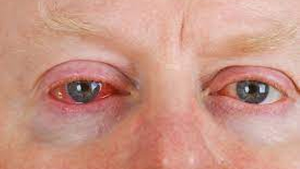 Pink Eye और Conjunctivitis एक ही है या दोनों में होता है अंतर, जानें ...