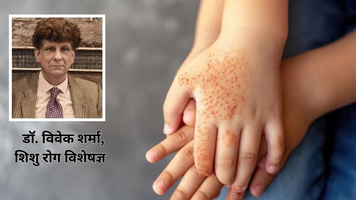 दिल्ली में बढ़े HFMD के मामले, एक्सपर्ट से जानें क‍ितनी खतरनाक है ये ...